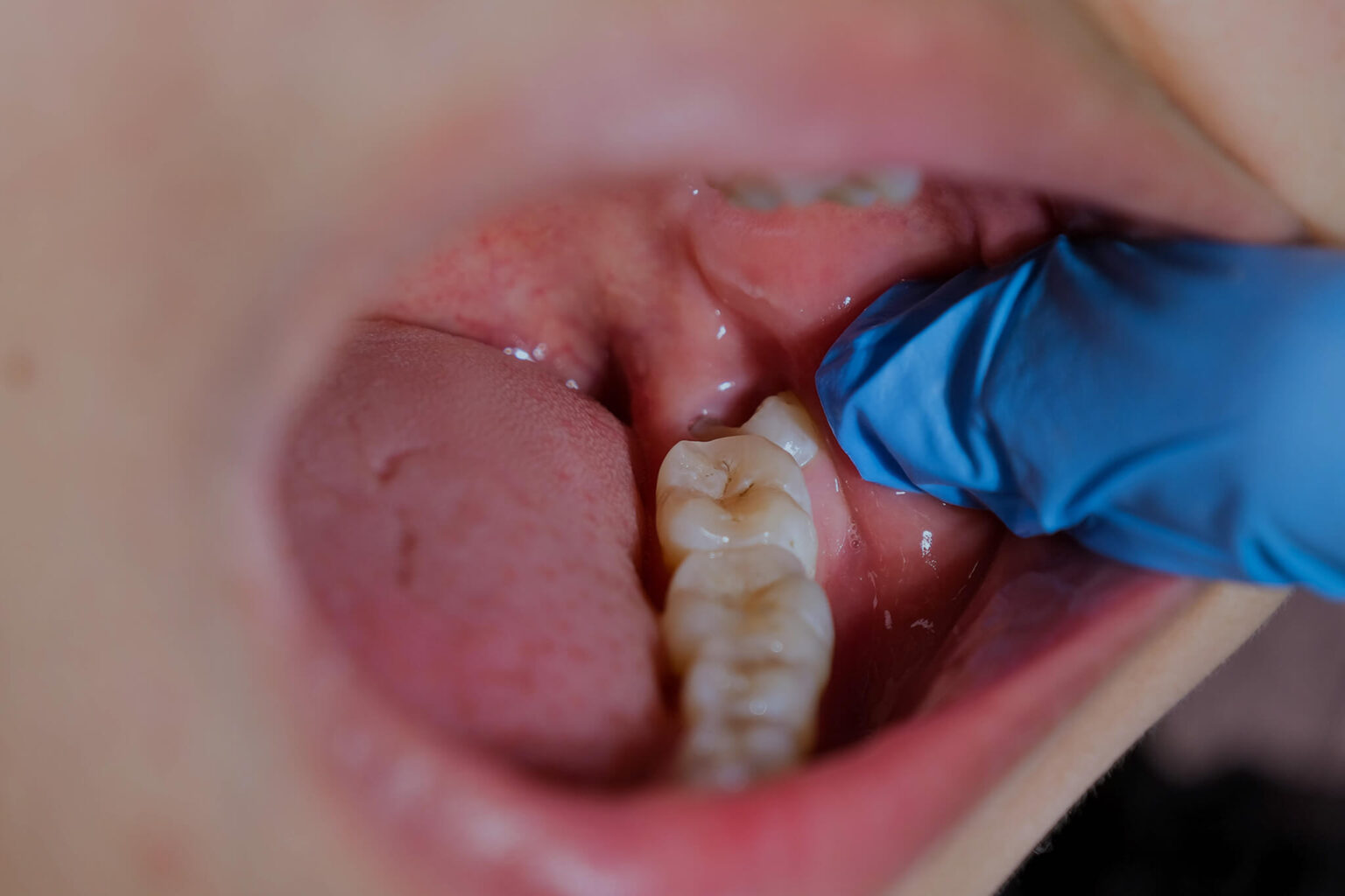 Operculectomy Dental Procedure - IML